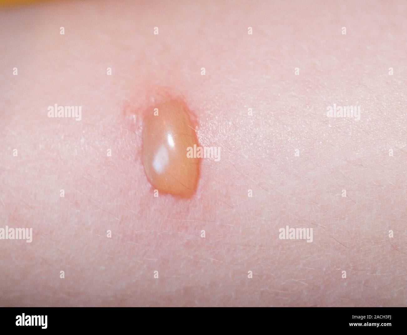 Poison Ivy (Toxicodendron radicans) on human skin Stock Photo - Alamy