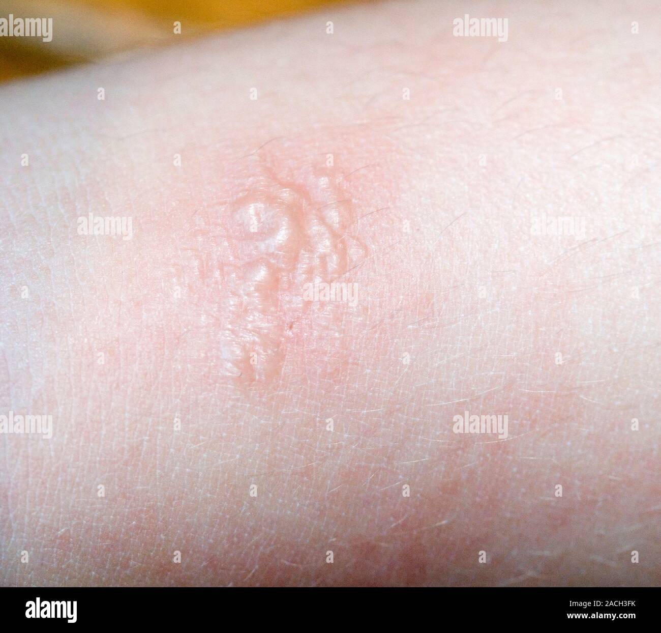 Dermatitis Toxicodendron Poison Ivy Dermatitis Rhus