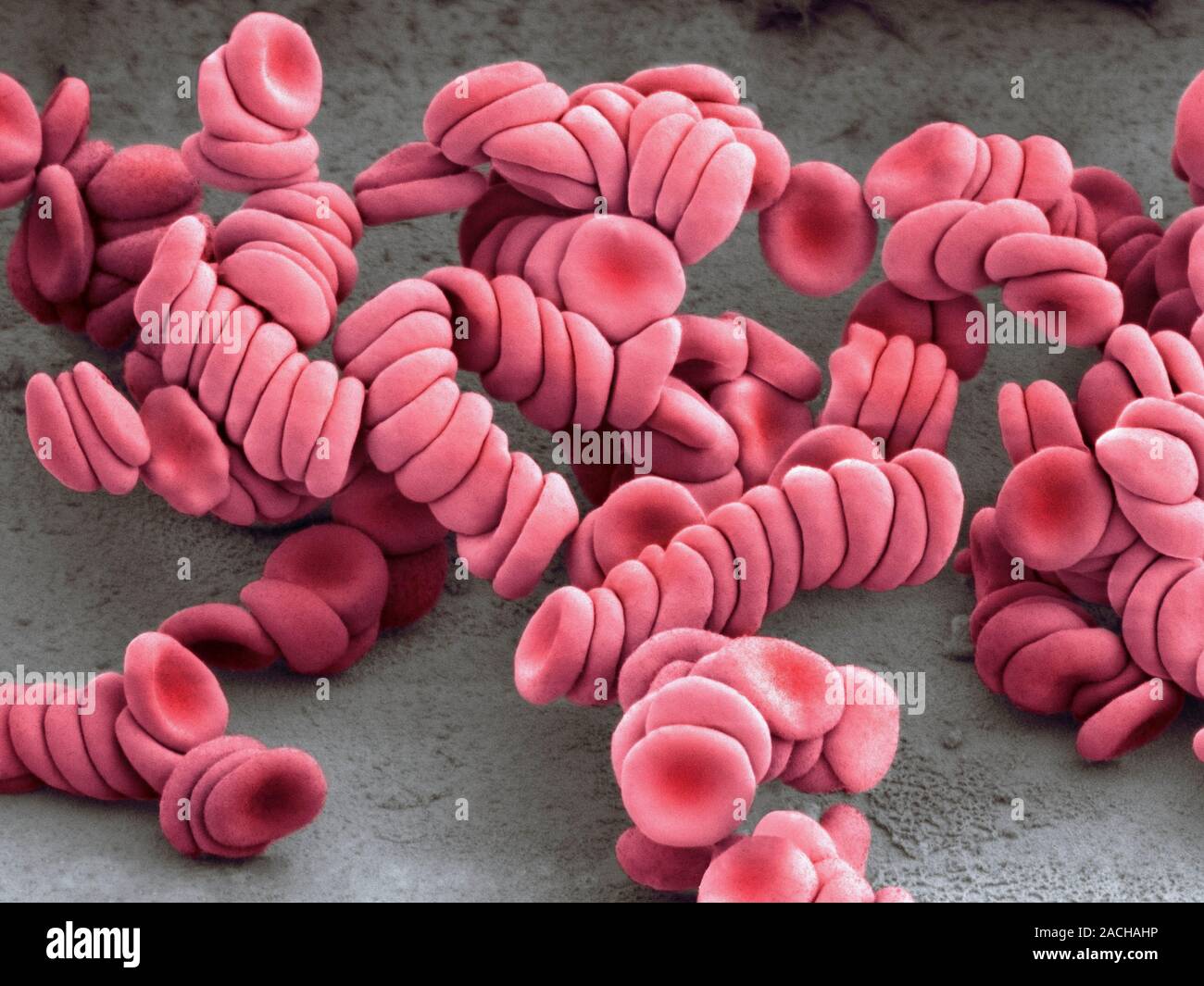 Rouleaux Cells Autoagglutination Vs Rouleaux Formation | Medical