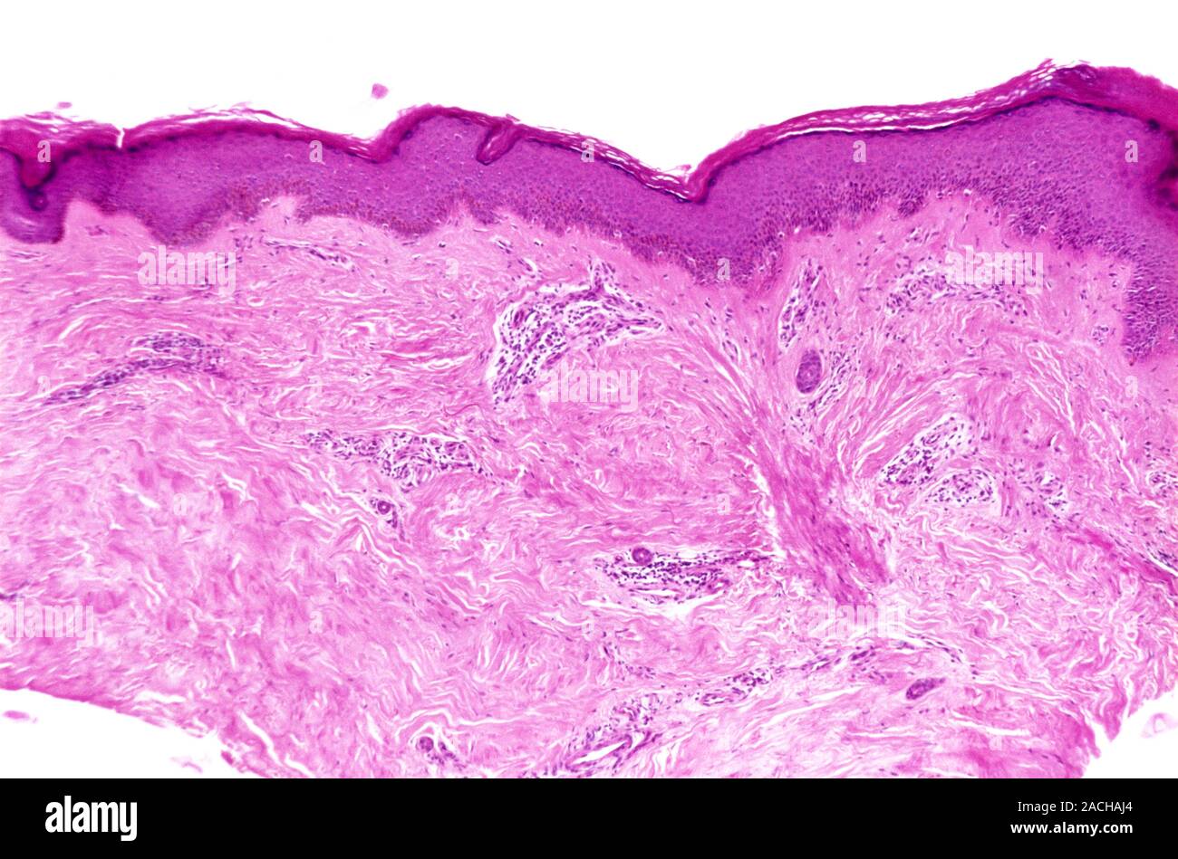 Keratoacanthoma. Light micrograph of a section through a ...