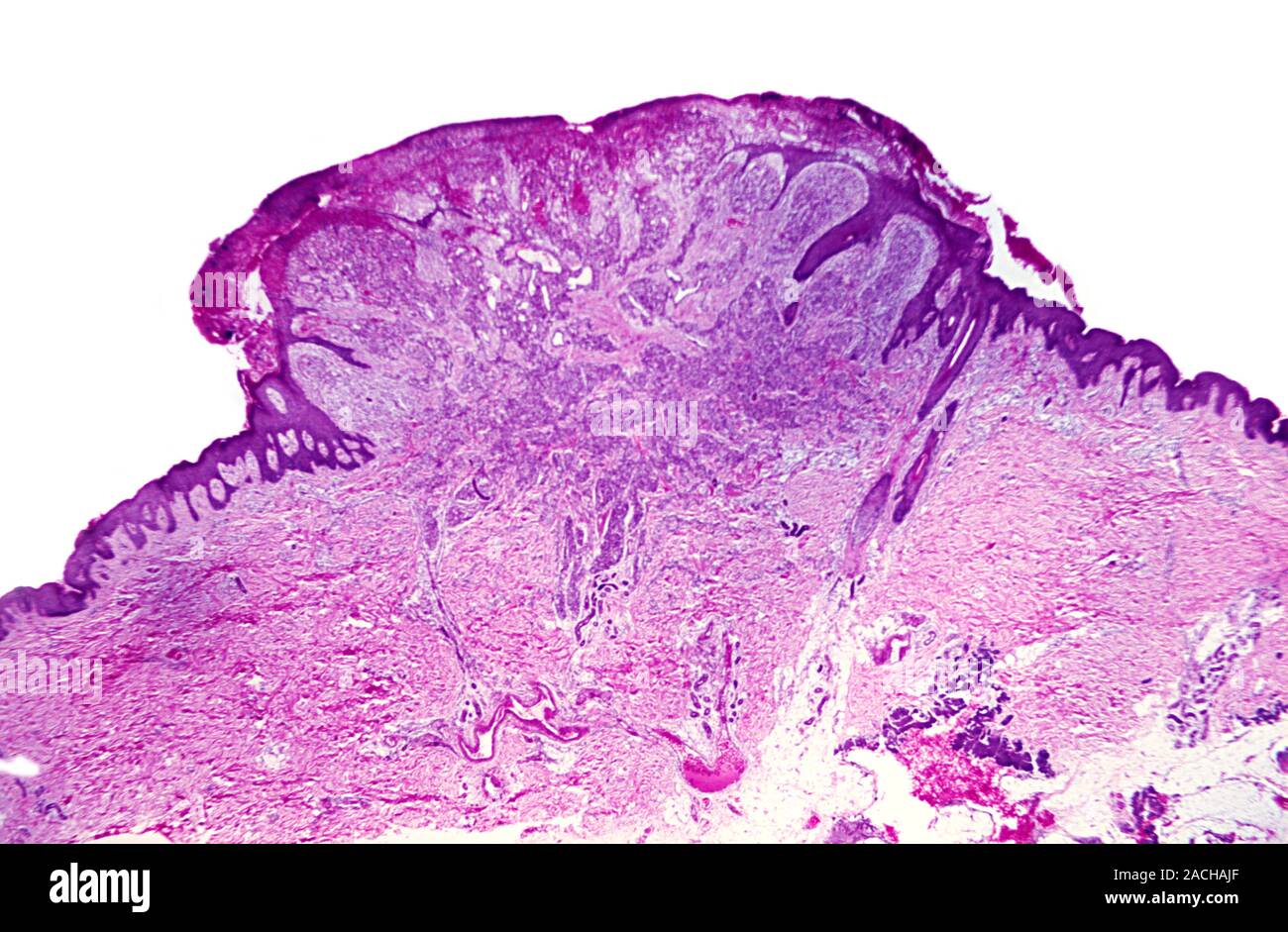 Pyogenic granuloma. Light micrograph of a section through a pyogenic ...