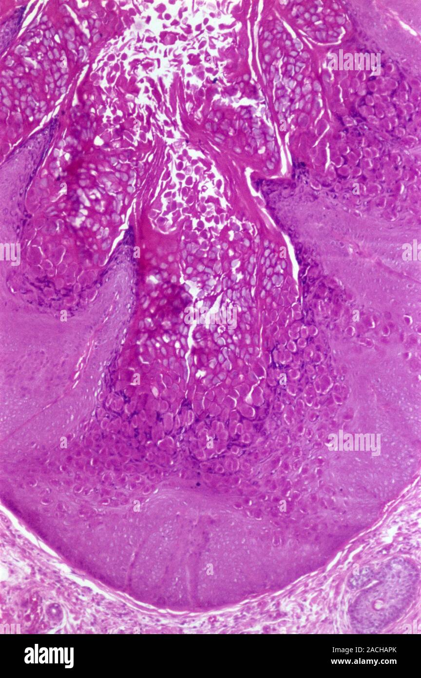 Molluscum contagiosum. Light micrograph of a section through human skin ...