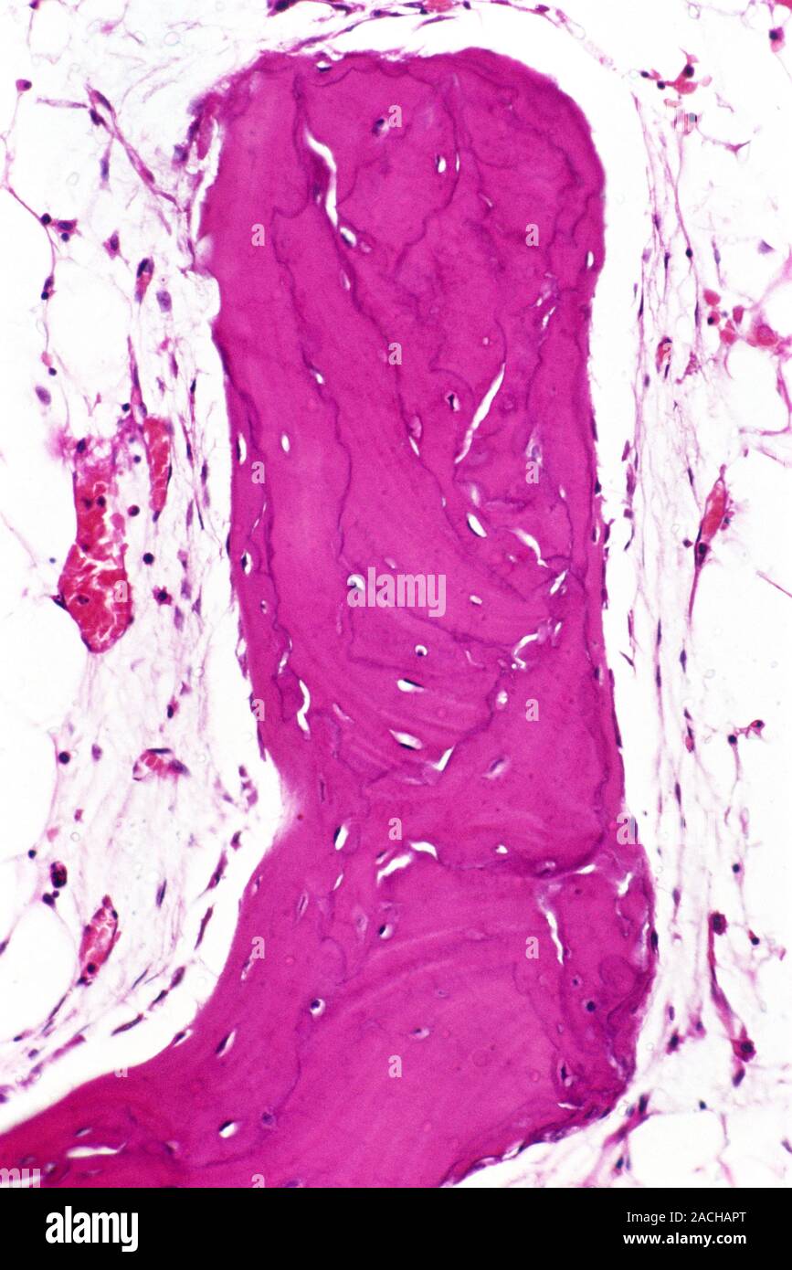 Paget's disease. Light micrograph of a section through bone tissue in ...