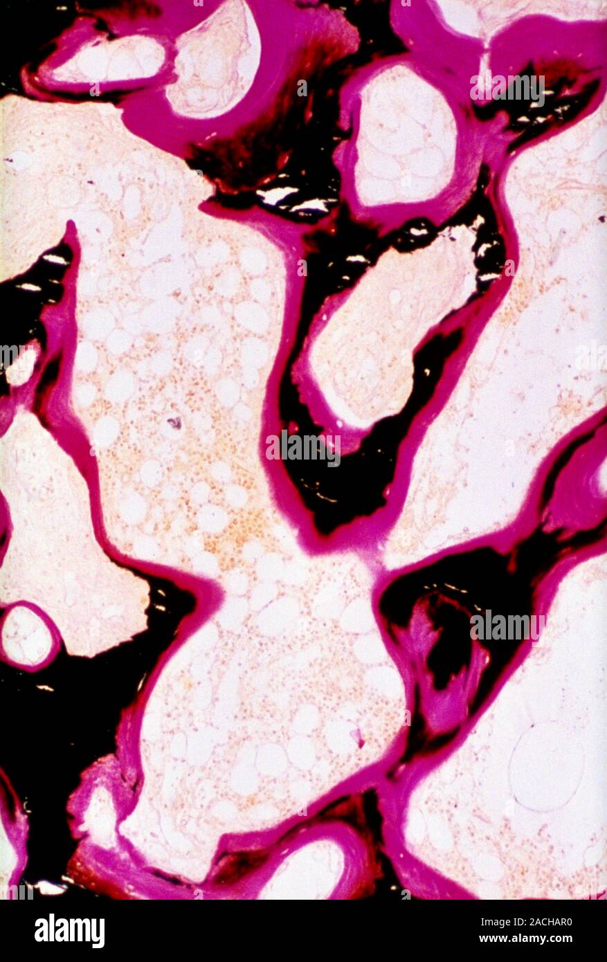 Osteomalacia. Light micrograph of a section through bone tissue in ...