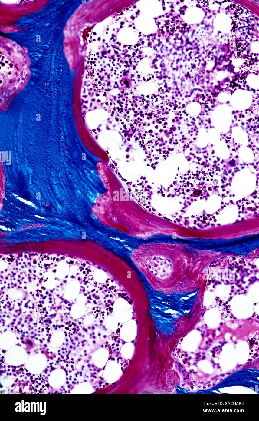 Osteomalacia. Light micrograph of a section through bone tissue in ...