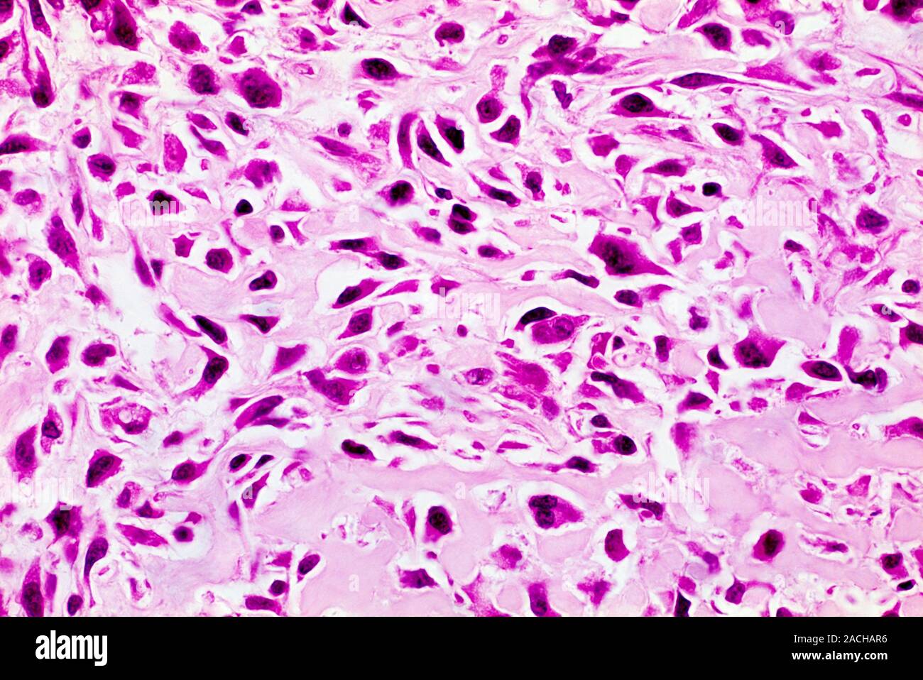 Bone cancer. Light micrograph of a section through bone tissue in a ...