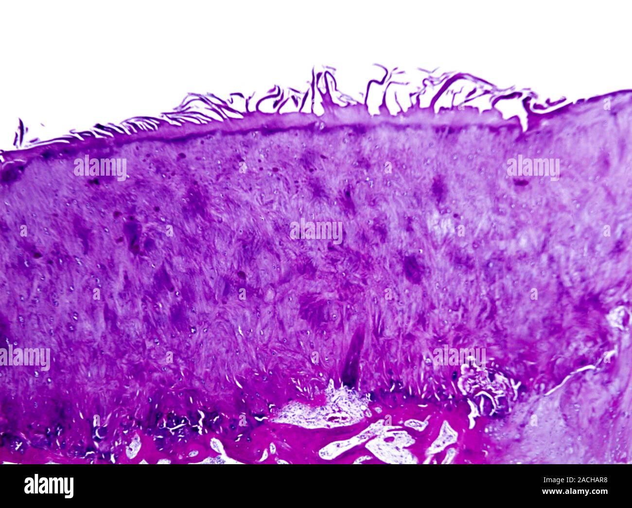 Osteoarthritis. Light micrograph of a section through joint tissue in a ...