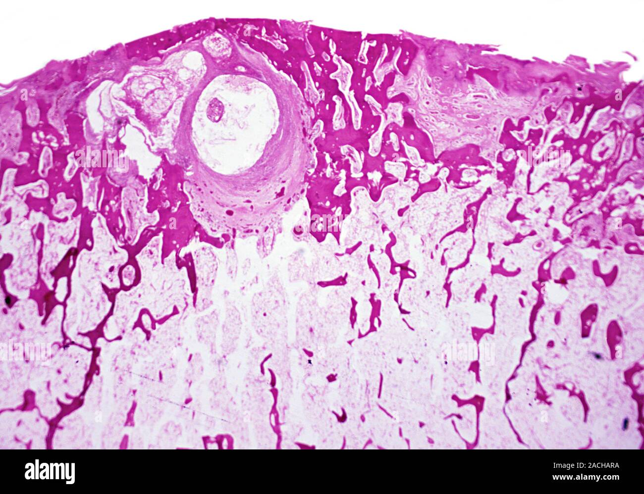 Osteoarthritis. Light micrograph of a section through joint tissue in a ...