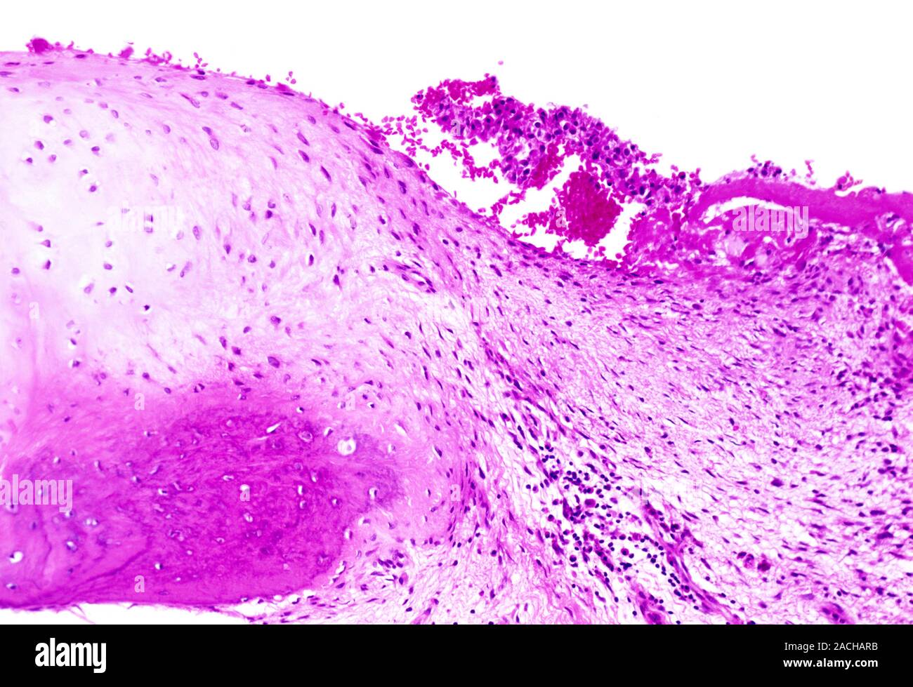 Rheumatoid arthritis. Light micrograph of a section through joint ...