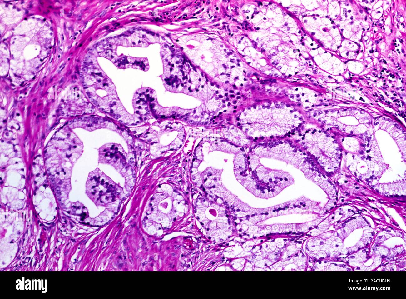 Prostate Hyperplasia Coloured Light Micrograph Of A Section Through A