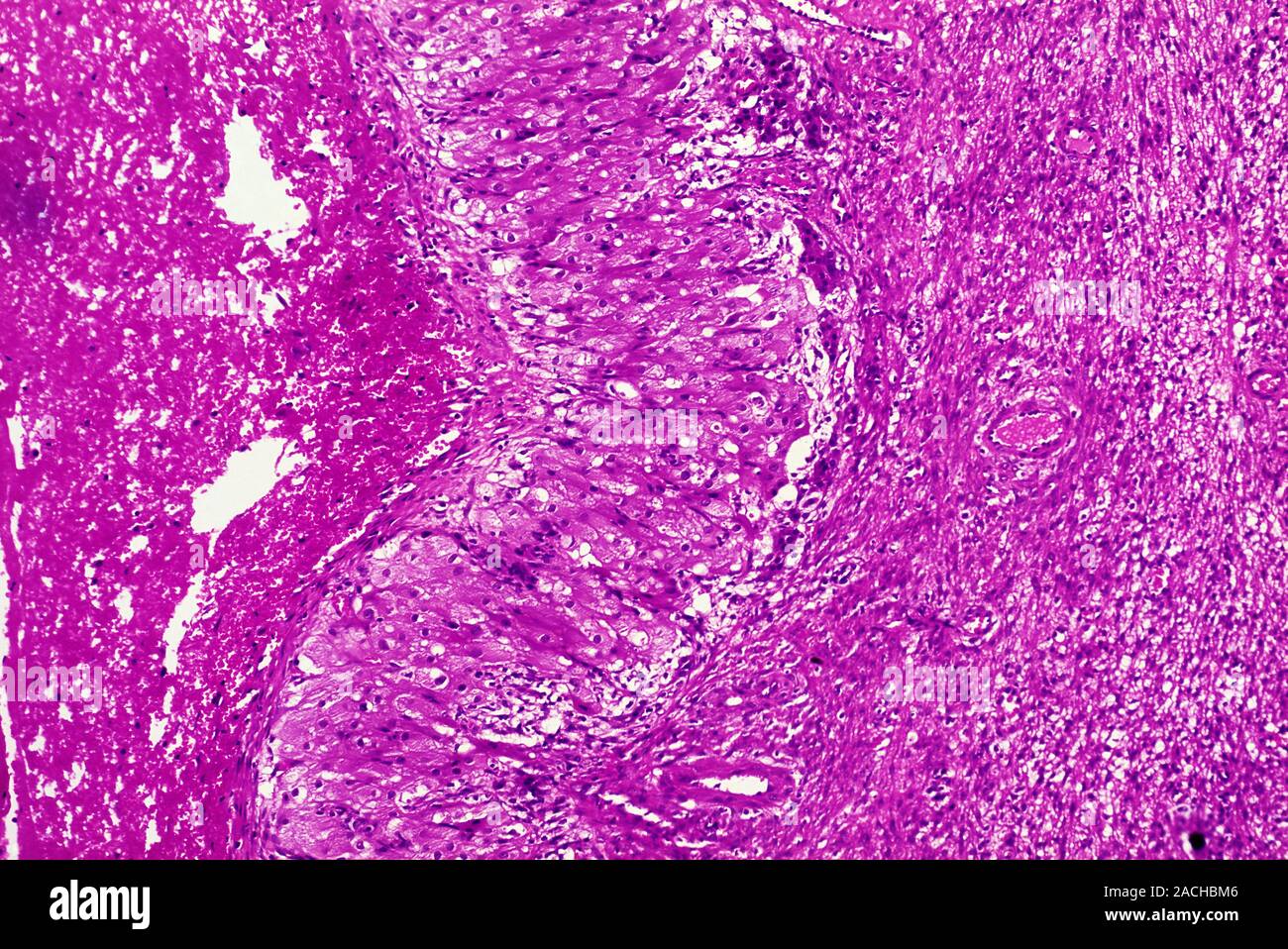 Ovarian cyst. Light micrograph of a section through a luteal cyst in an ...