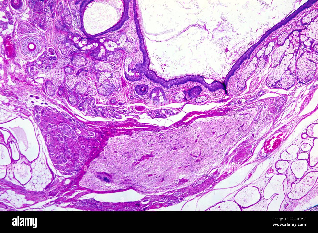 Ovarian tumour. Light micrograph of a section through a benign (non ...