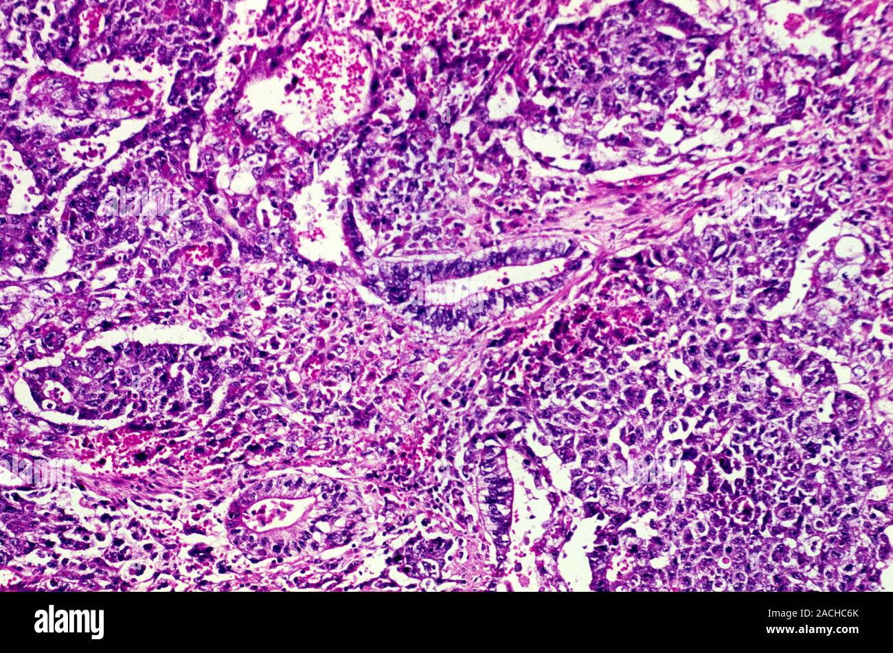 Testicular Cancer Light Micrograph Of A Section Through An