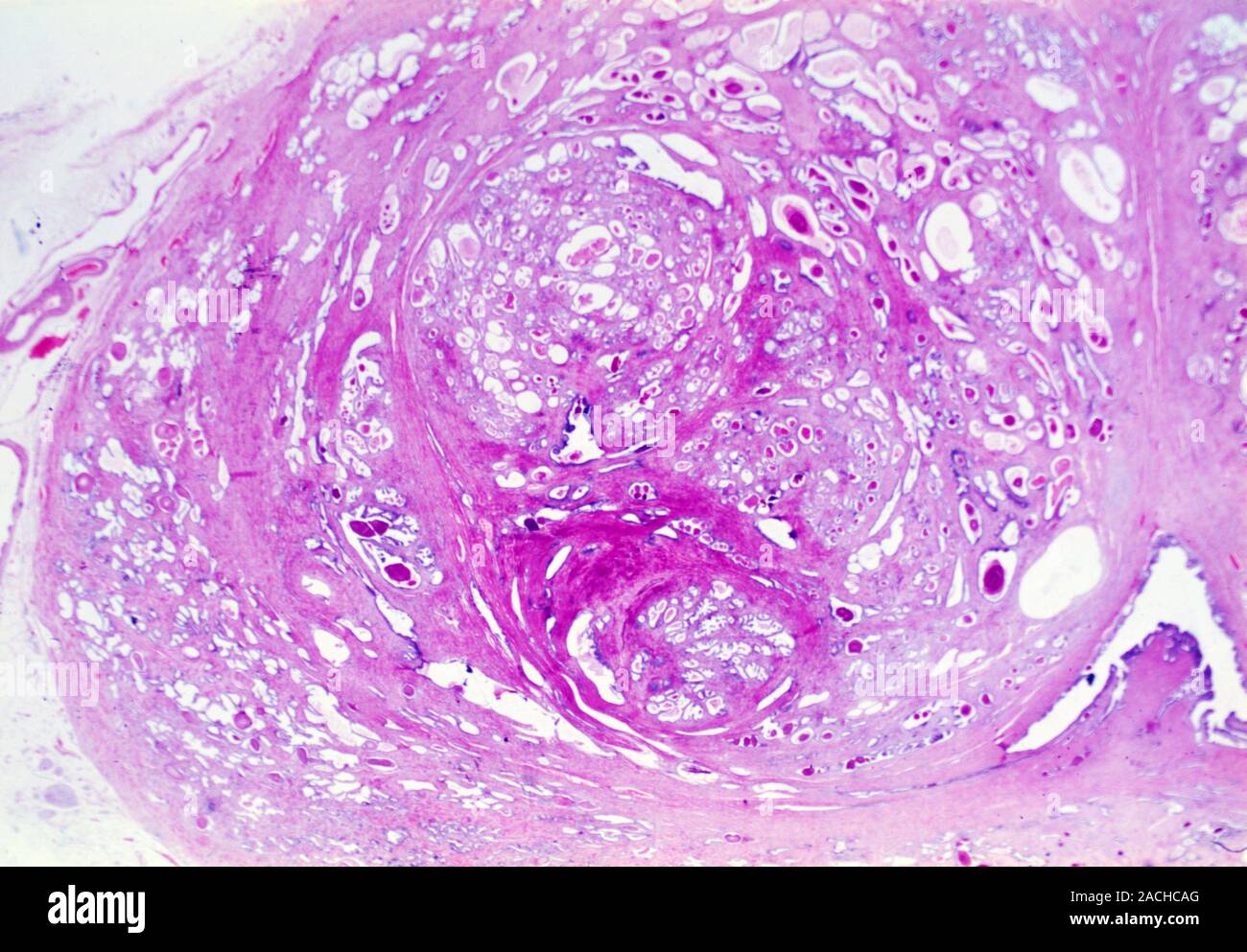 Prostate hyperplasia. Coloured light micrograph of a section through a ...