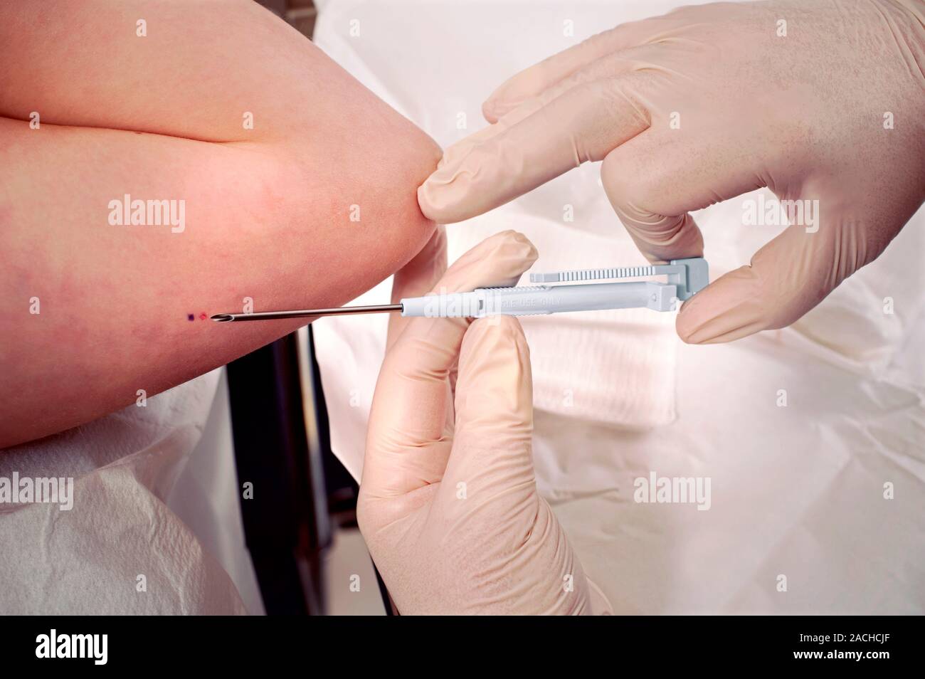 Contraceptive implant. Woman having a tube filled with progestin, a ...
