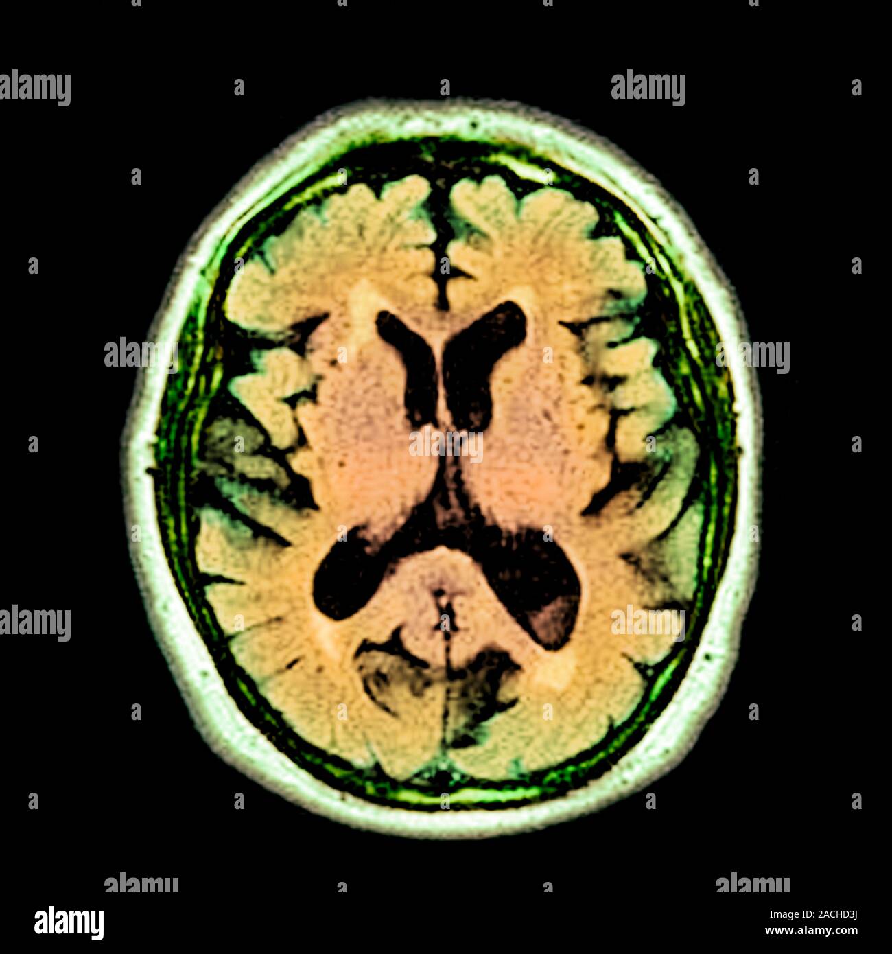 Alcoholic dementia. Coloured magnetic resonance imaging (MRI) scan of ...