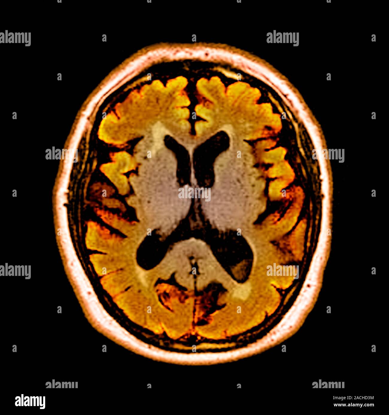 Alcoholic dementia. Coloured magnetic resonance imaging (MRI) scan of ...