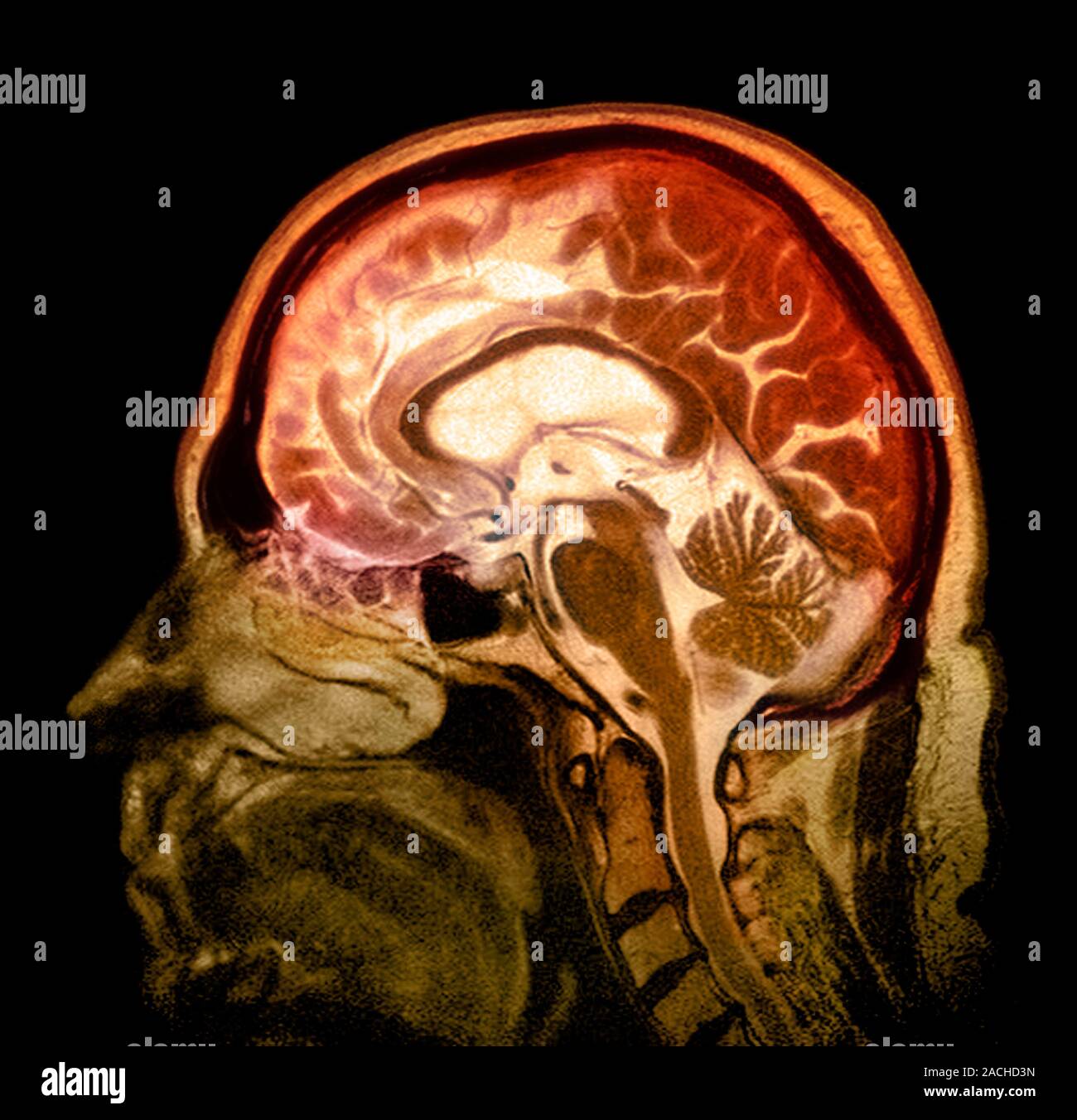 Alcoholic dementia. Coloured magnetic resonance imaging (MRI) scan of ...