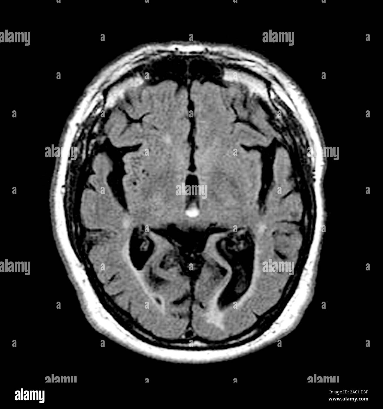 Alcoholic dementia. Magnetic resonance imaging (MRI) scan of the brain ...