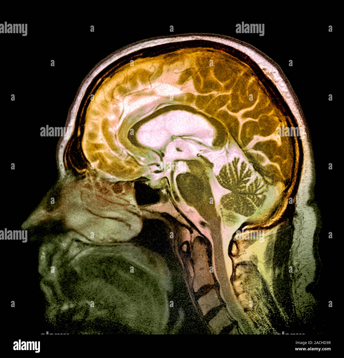 Alcoholic dementia. Coloured magnetic resonance imaging (MRI) scan of ...