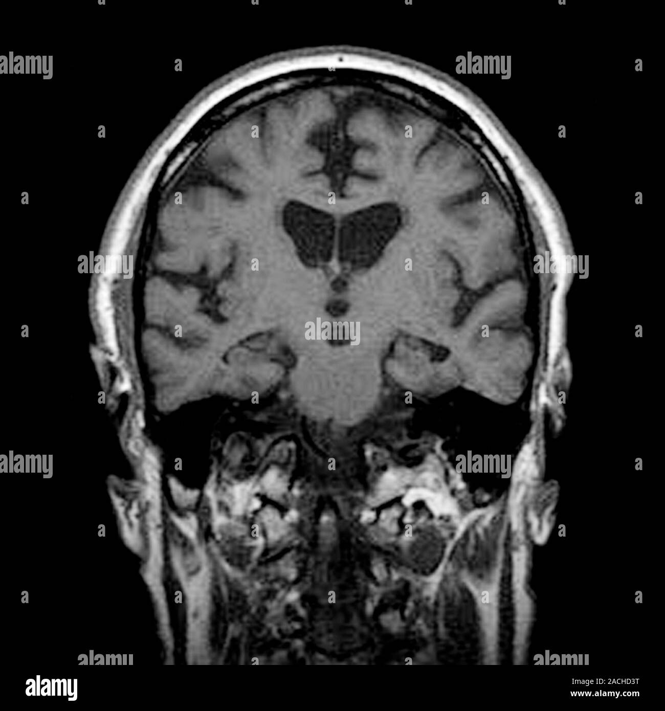 Alcoholic dementia. Magnetic resonance imaging (MRI) scan of the brain ...