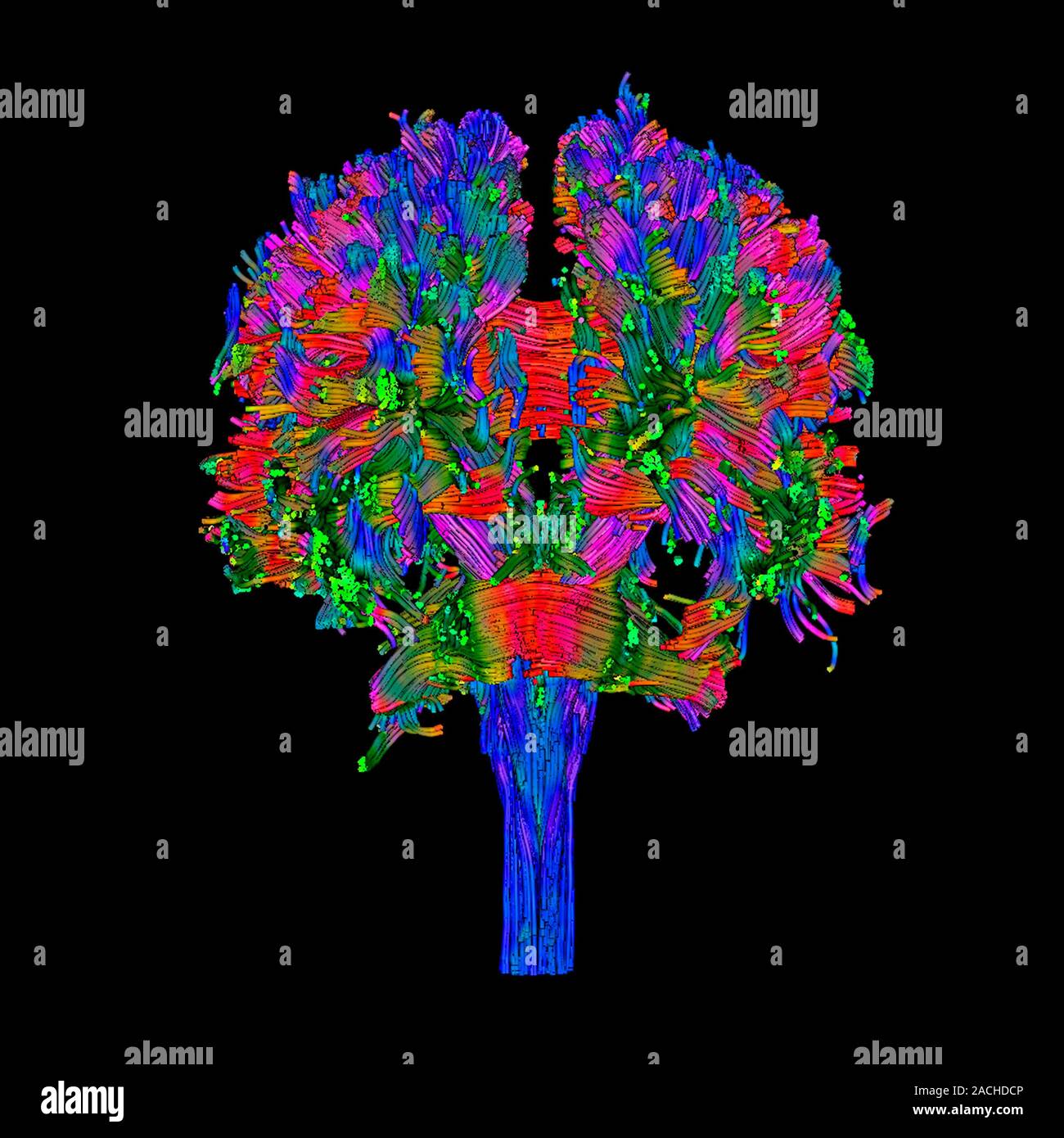 White matter fibres. Coloured 3D diffusion tensor imaging (DTI) scan of the brain, showing the ...