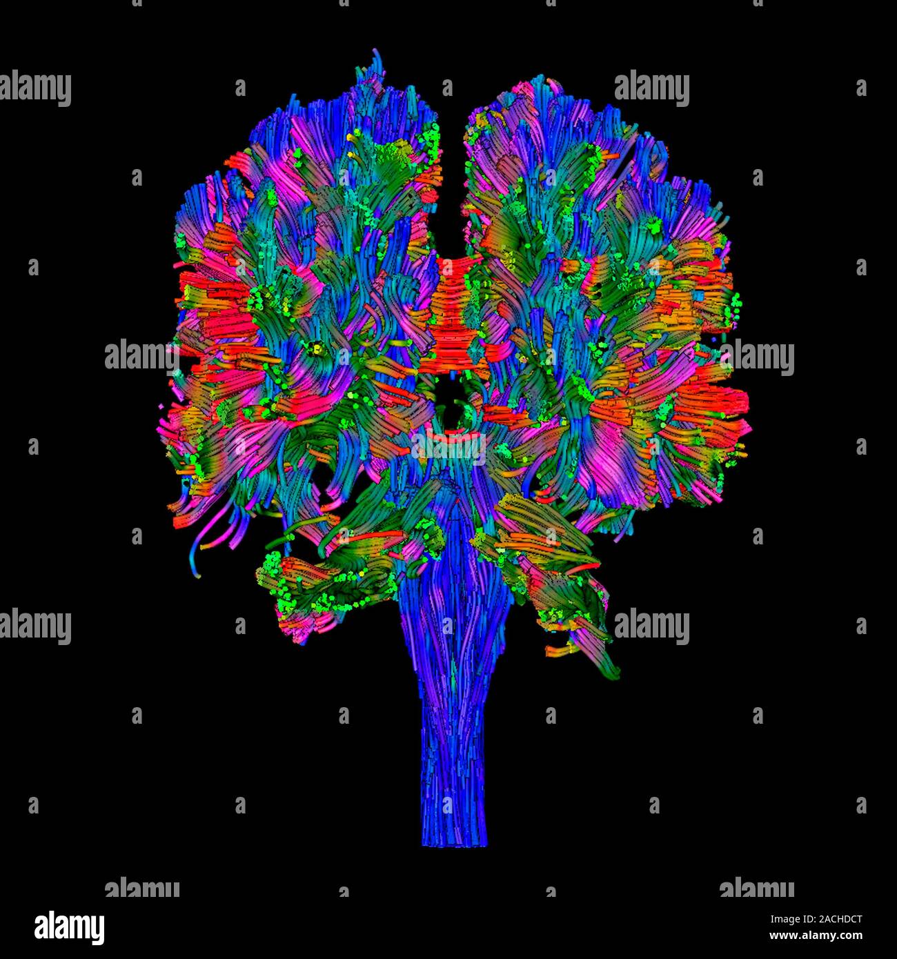 White matter fibres. Coloured 3D diffusion tensor imaging (DTI) scan of the brain, showing the ...