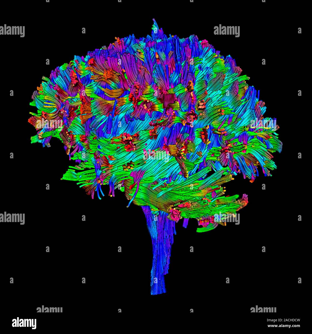 White matter fibres. Coloured 3D diffusion tensor imaging (DTI) scan of the brain, showing the ...