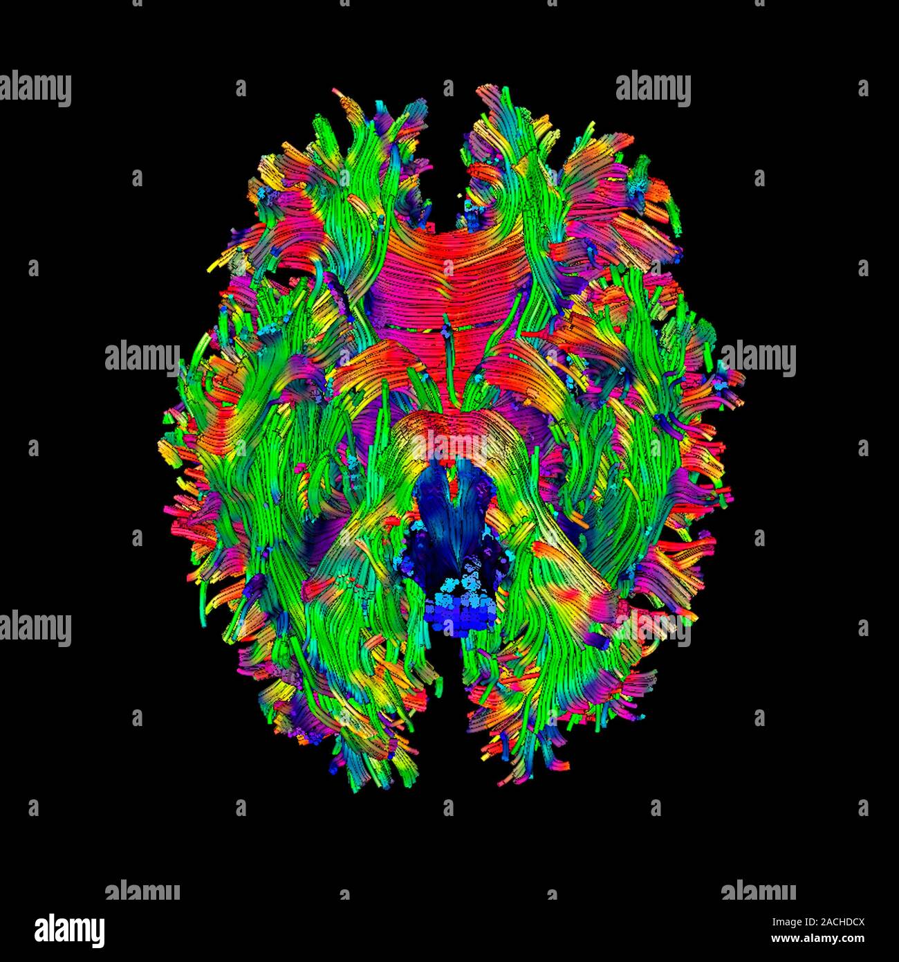 White matter fibres. Coloured 3D diffusion tensor imaging (DTI) scan of the brain, showing the ...