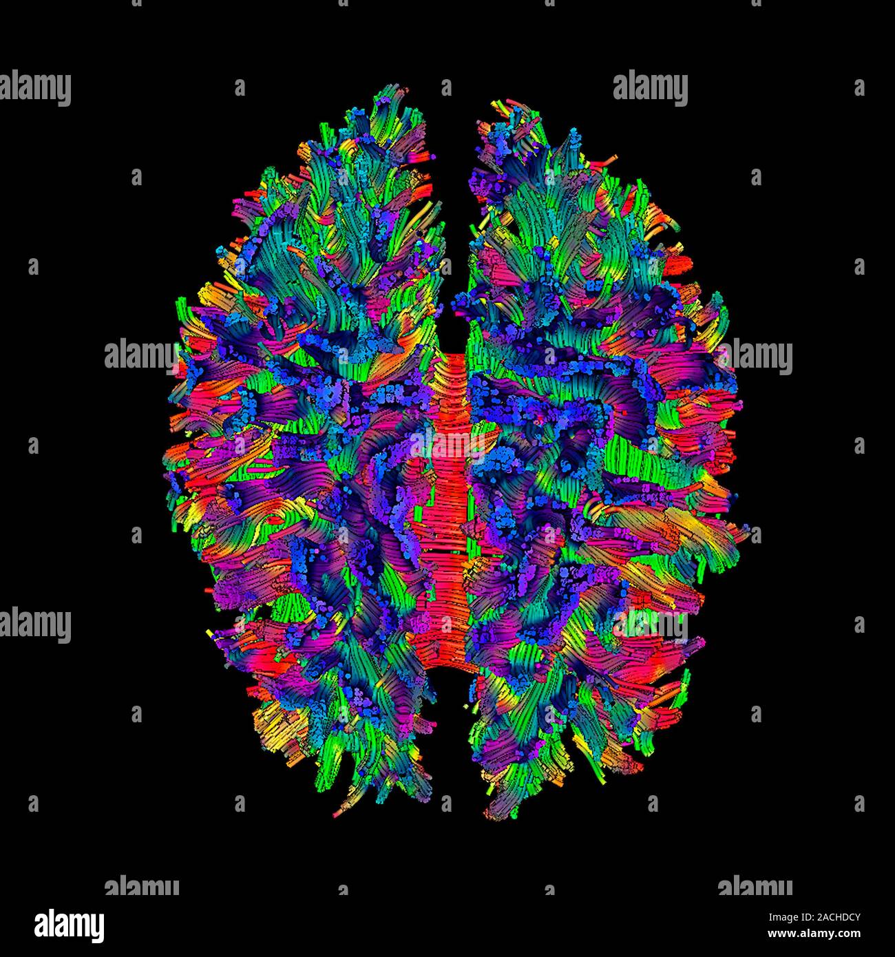 White matter fibres. Coloured 3D diffusion tensor imaging (DTI) scan of the brain, showing the ...