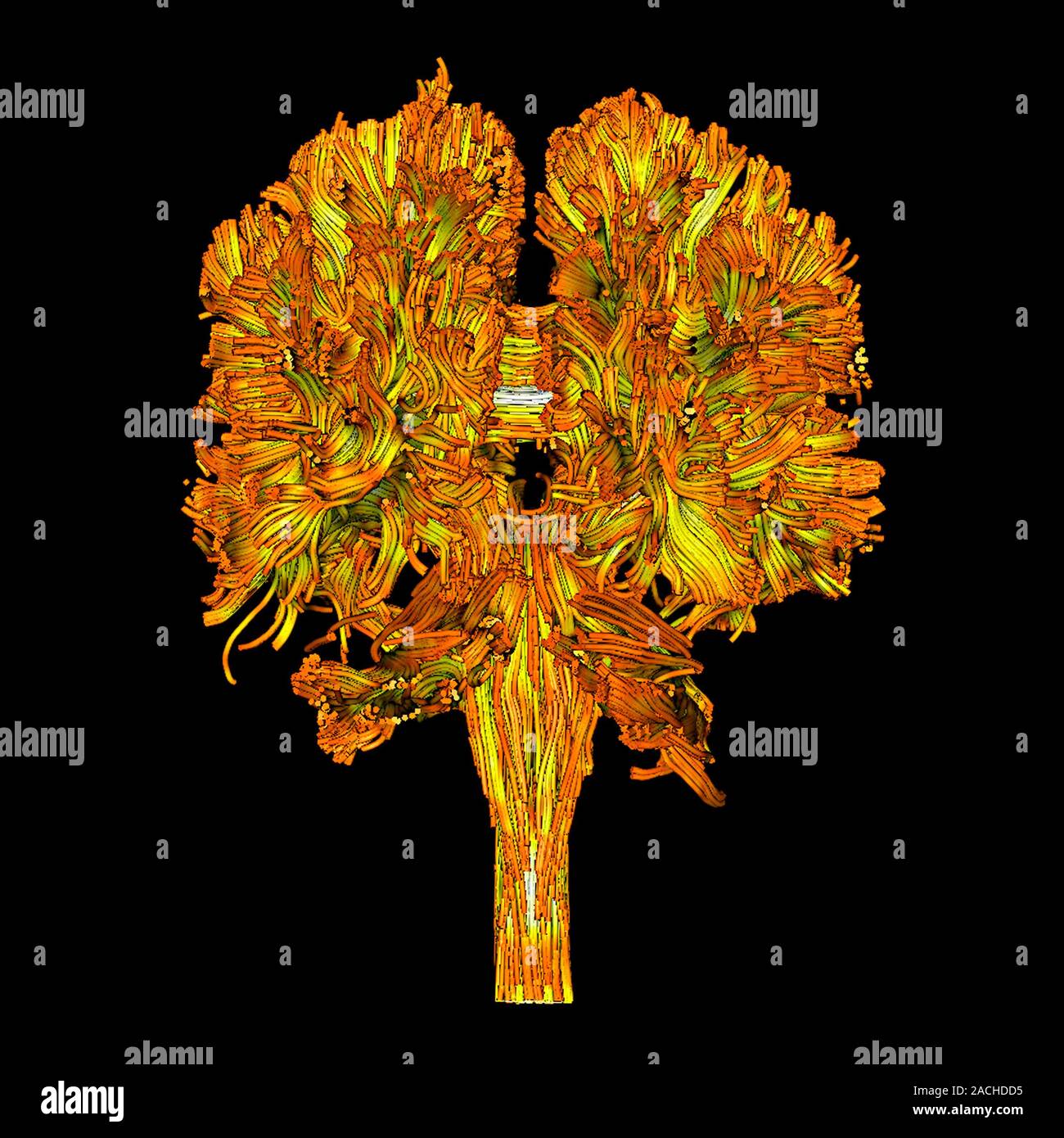 White matter fibres. Coloured 3D diffusion tensor imaging (DTI) scan of the brain, showing the ...