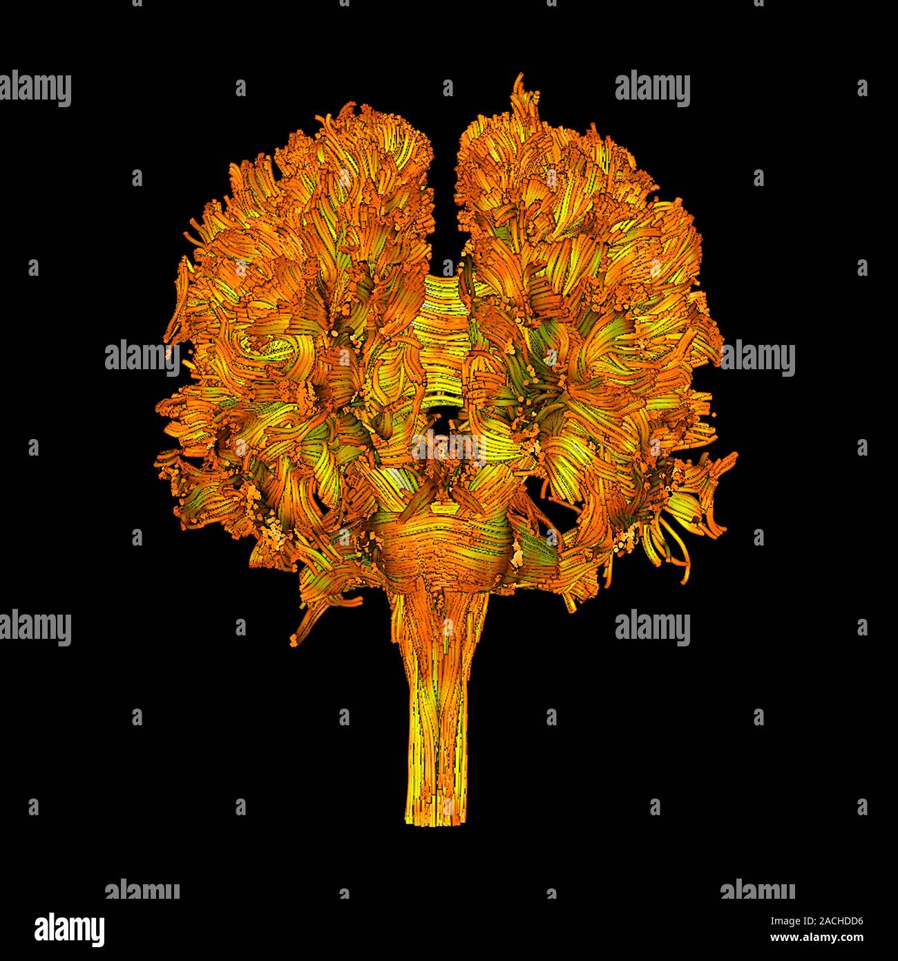 White matter fibres. Coloured 3D diffusion tensor imaging (DTI) scan of the brain, showing the ...