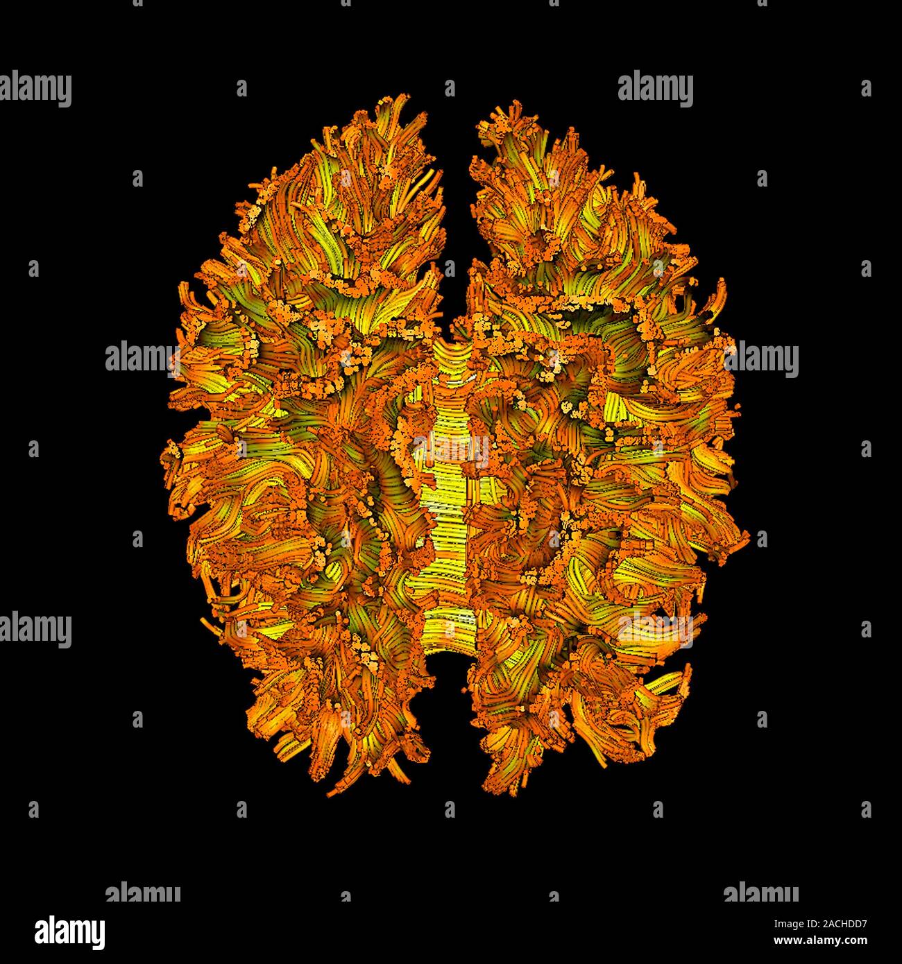 White matter fibres. Coloured 3D diffusion tensor imaging (DTI) scan of the brain, showing the ...