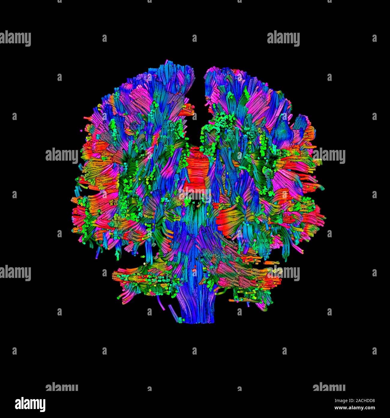 Brain Tumour Coloured 3d Diffusion Tensor Imaging Dti Scan Of The