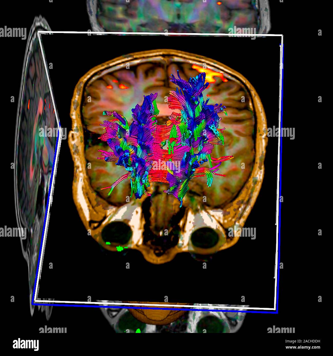 Brain tumour. Coloured 3D diffusion tensor imaging (DTI) and magnetic resonance imaging (MRI ...