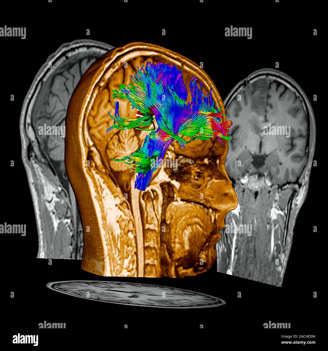 Brain tumour. Coloured 3D diffusion tensor imaging (DTI) and magnetic resonance imaging (MRI ...