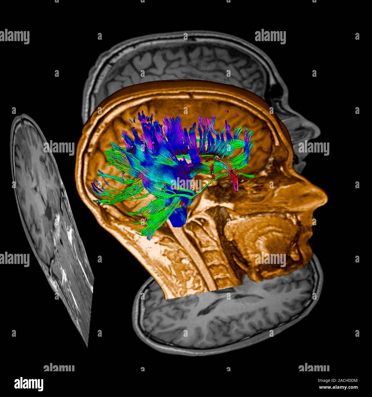 Brain tumour. Coloured 3D diffusion tensor imaging (DTI) and magnetic resonance imaging (MRI ...