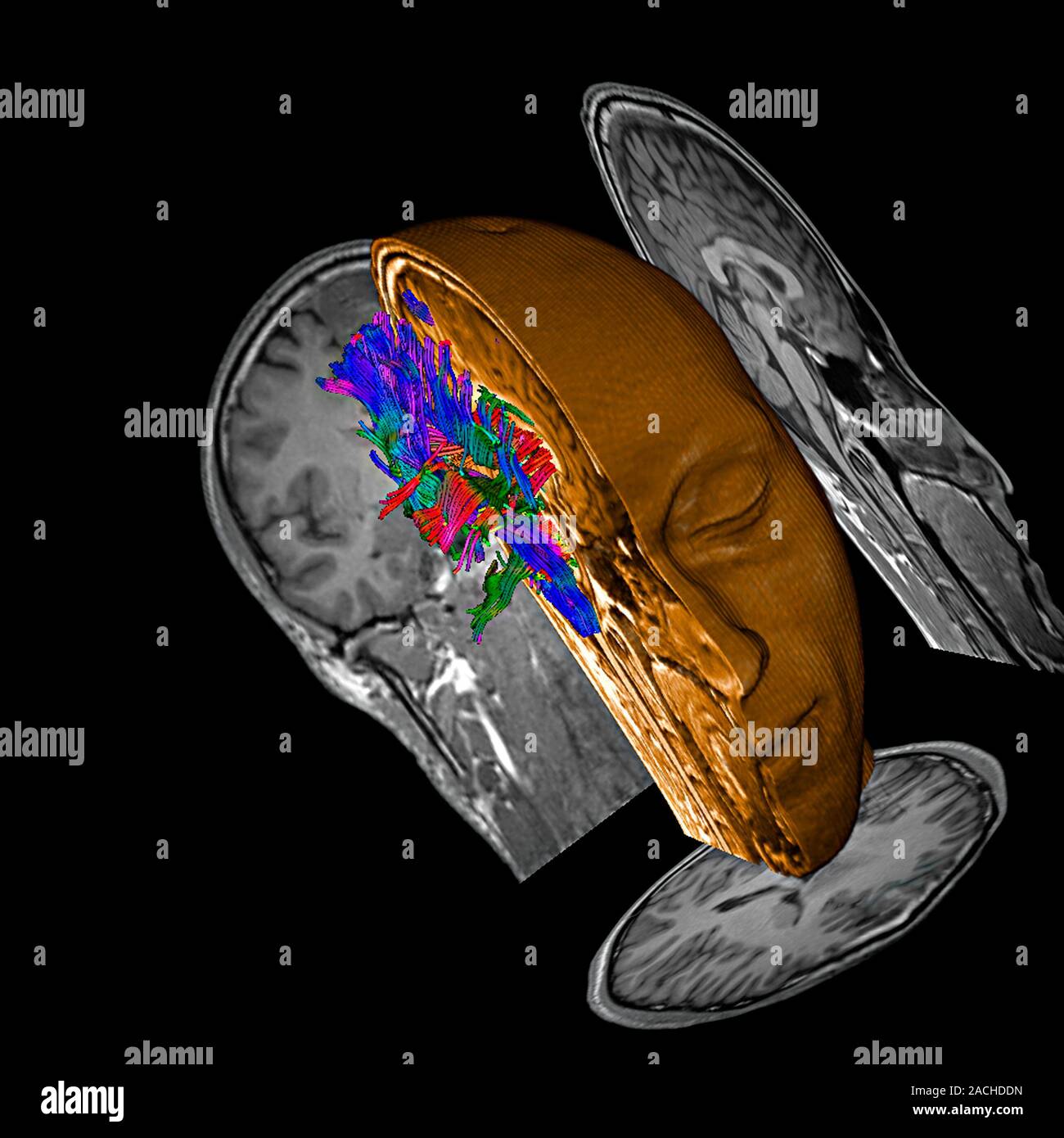 Brain tumour. Coloured 3D diffusion tensor imaging (DTI) and magnetic resonance imaging (MRI ...