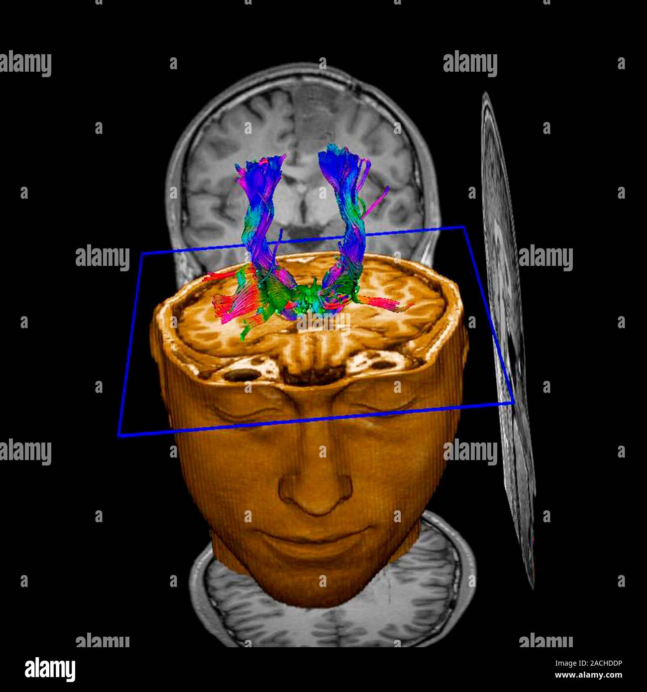 Brain tumour. Coloured 3D diffusion tensor imaging (DTI) and magnetic resonance imaging (MRI ...