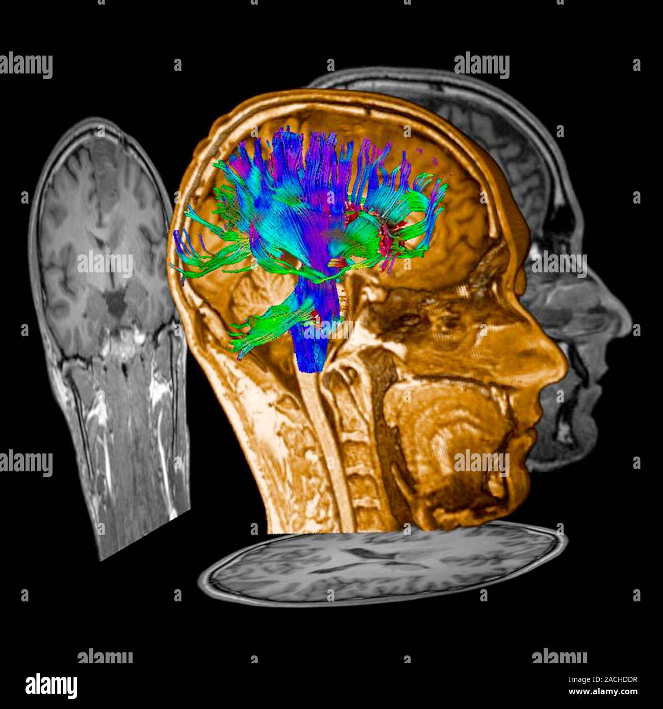 Brain tumour. Coloured 3D diffusion tensor imaging (DTI) and magnetic resonance imaging (MRI ...