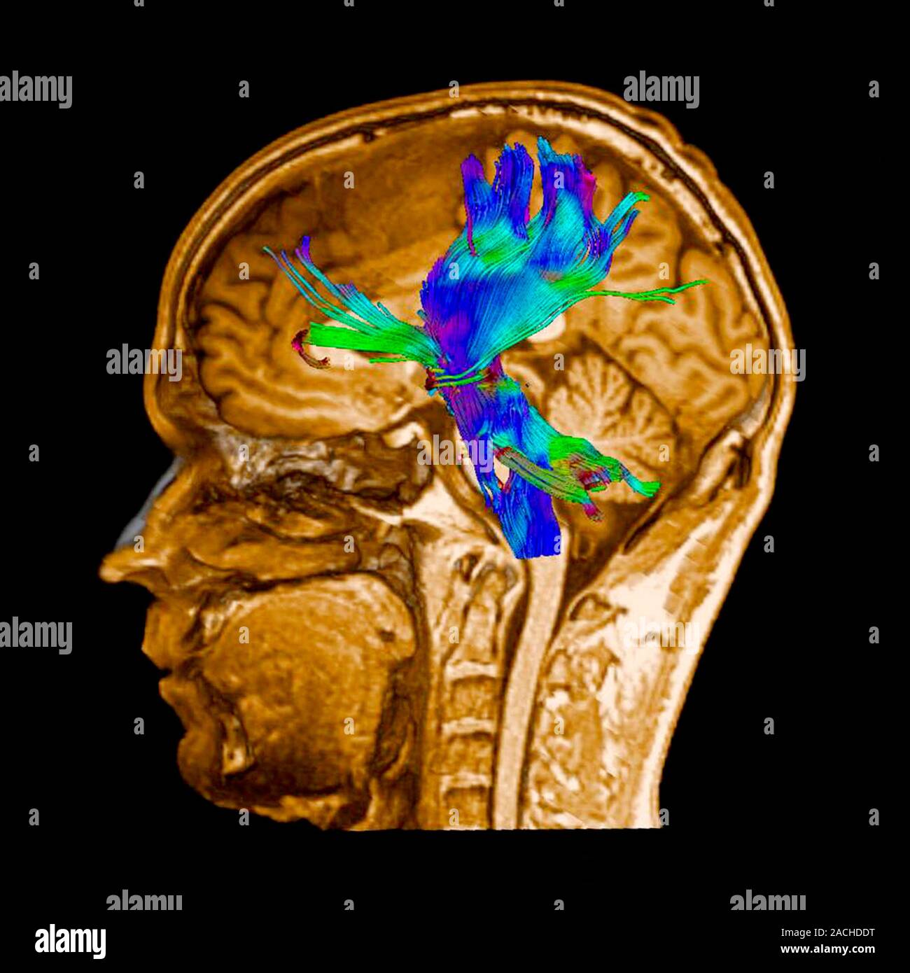 Brain tumour. Coloured 3D diffusion tensor imaging (DTI) and magnetic resonance imaging (MRI ...