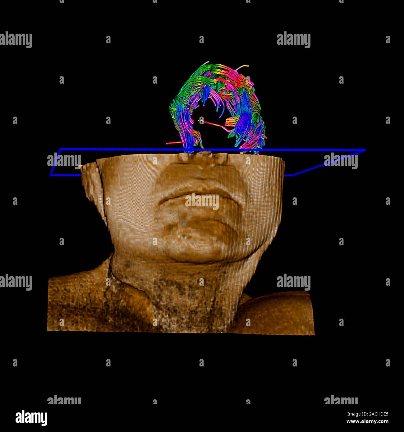 Brain tumour. Coloured 3D diffusion tensor imaging (DTI) and magnetic resonance imaging (MRI ...