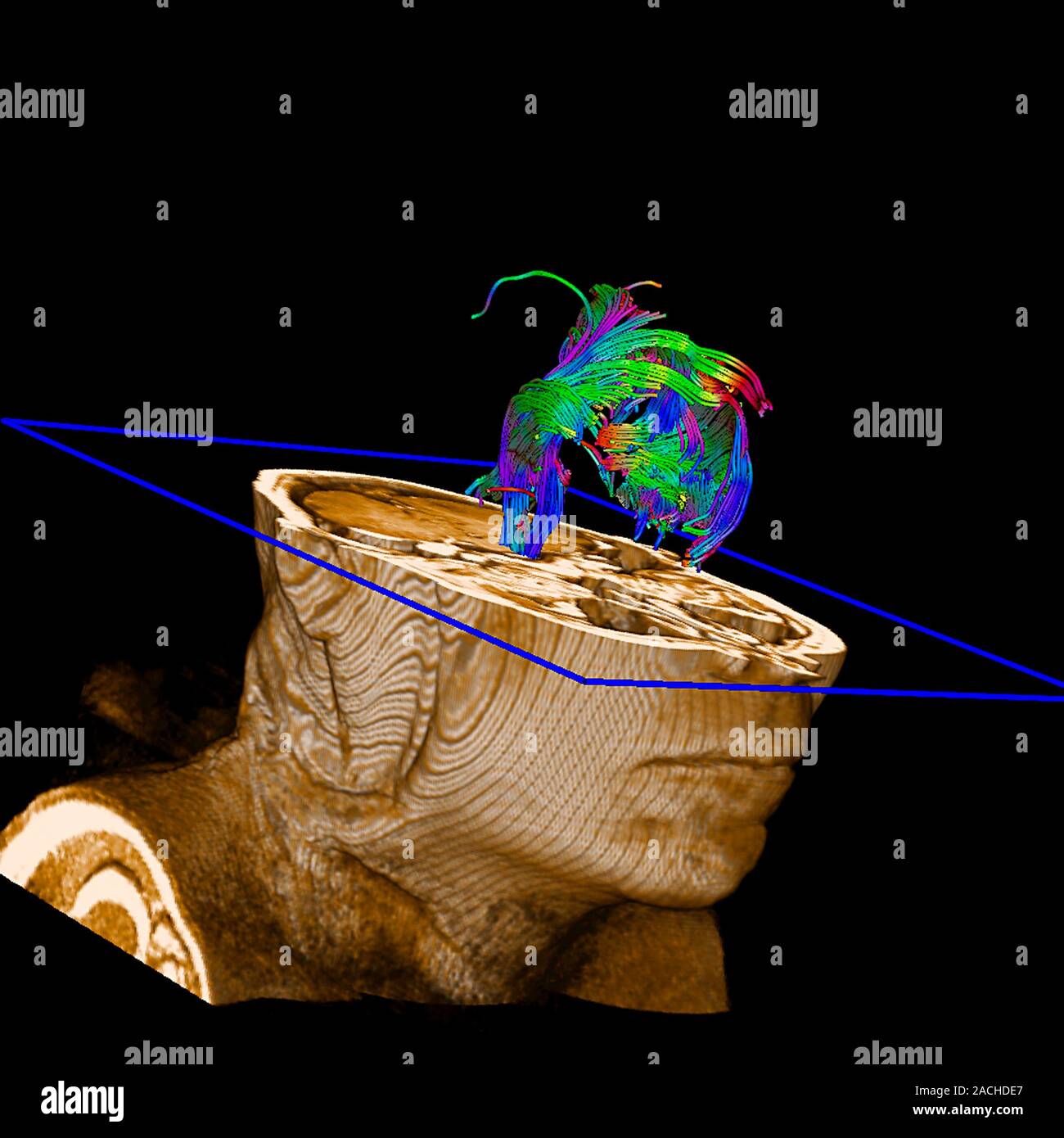Brain tumour. Coloured 3D diffusion tensor imaging (DTI) and magnetic resonance imaging (MRI ...