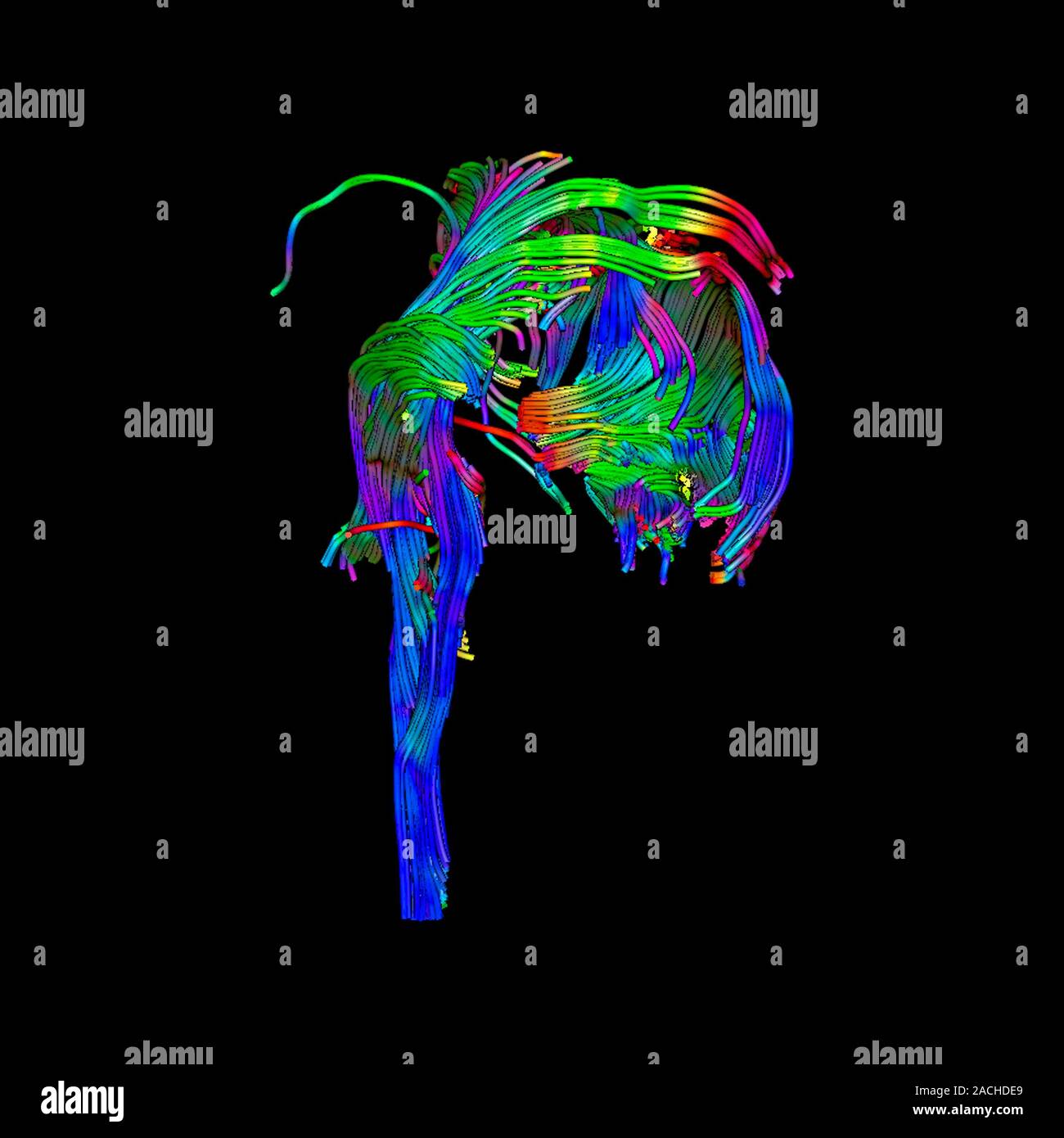 Brain tumour. Coloured 3D diffusion tensor imaging (DTI) scan of the brain of a 64 year old with ...