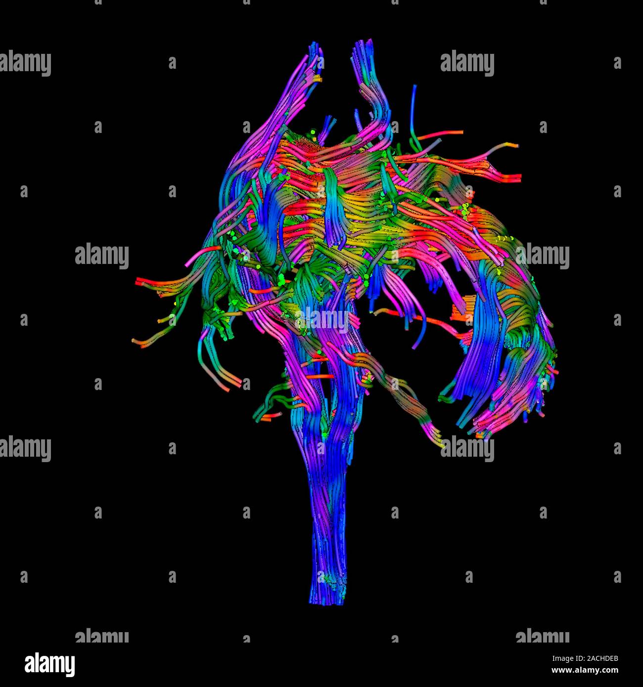 Brain tumour. Coloured 3D diffusion tensor imaging (DTI) scan of the brain of a 64 year old with ...