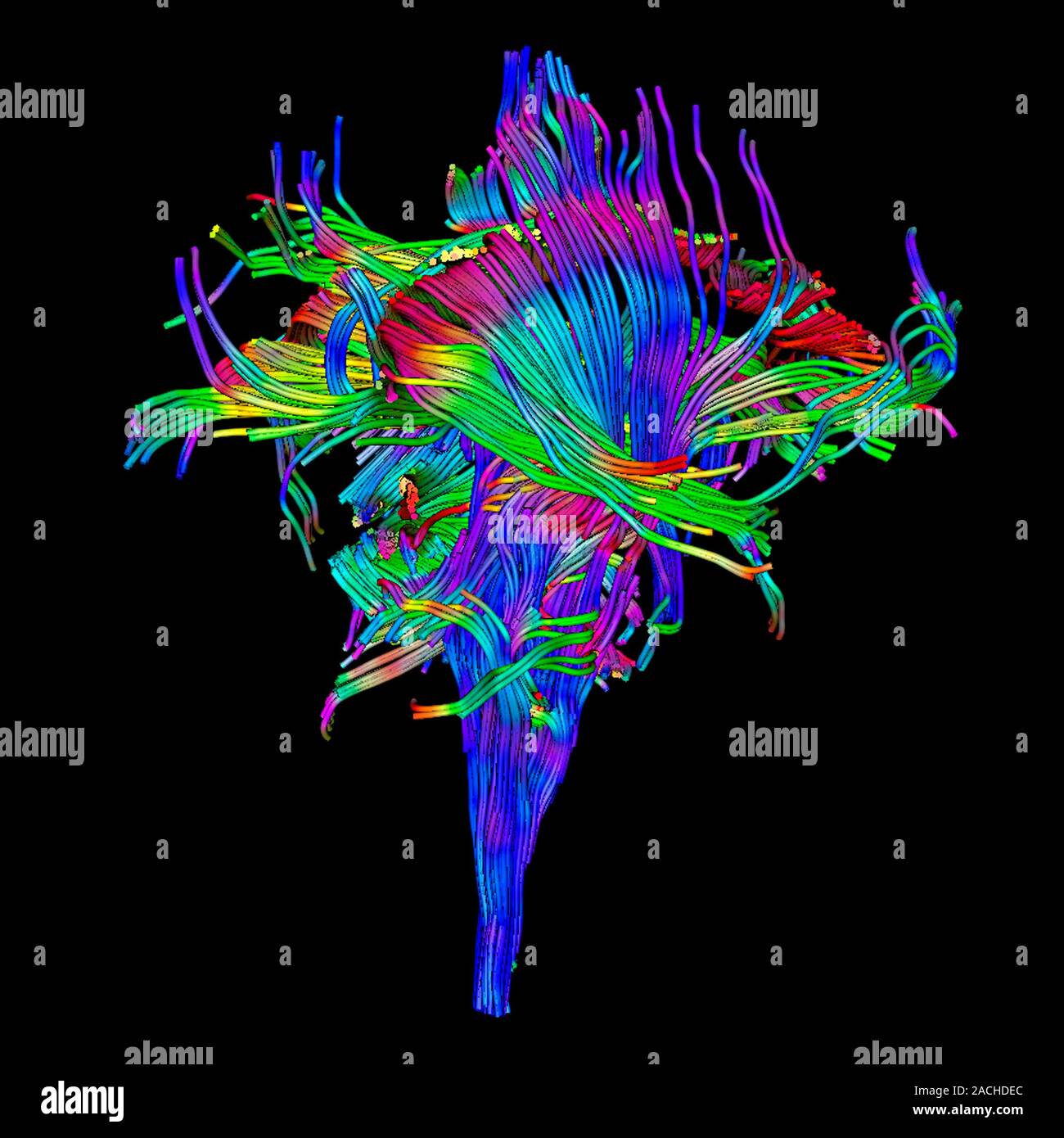 Brain tumour. Coloured 3D diffusion tensor imaging (DTI) scan of the brain of a 64 year old with ...