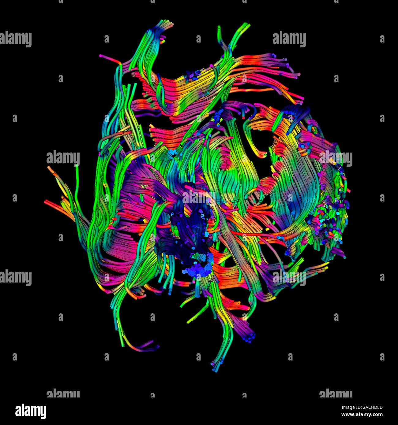 Brain tumour. Coloured 3D diffusion tensor imaging (DTI) scan of the brain of a 64 year old with ...