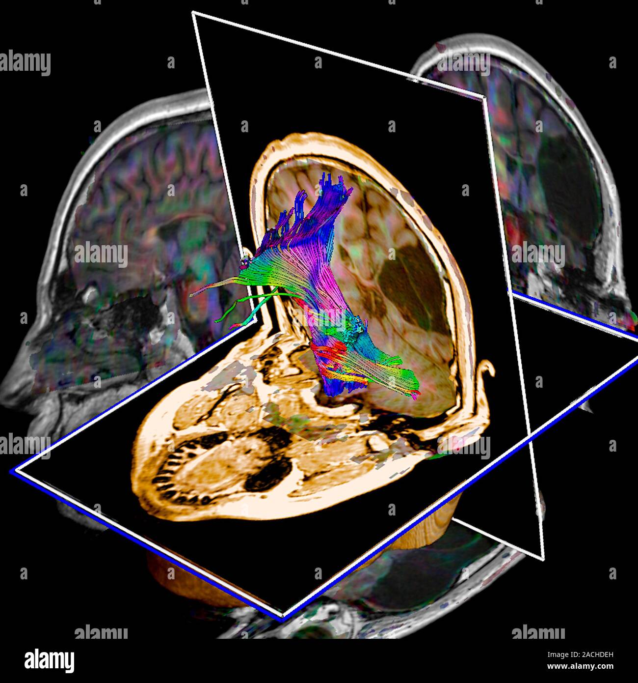 Cerebral palsy. Coloured 3D diffusion tensor imaging (DTI) and magnetic resonance imaging (MRI ...