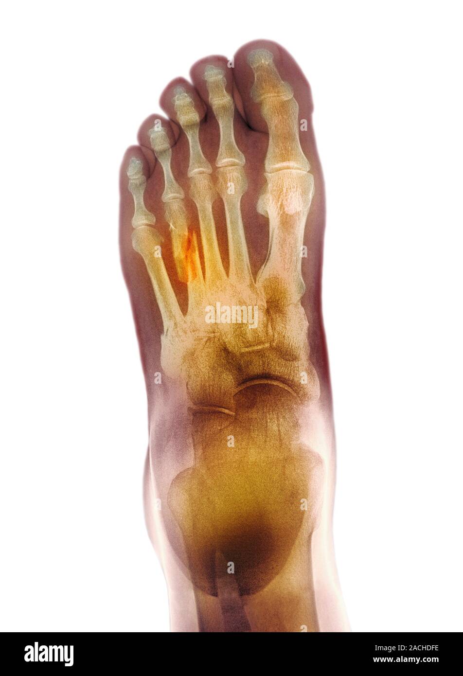 Fractured foot. Coloured X-ray of a foot with a fractured (bright ...