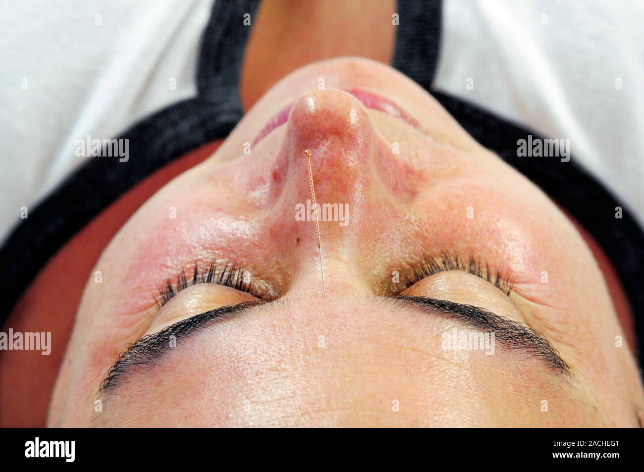 Acupuncture treatment. Close-up of an acupuncture needle in a woman's ...
